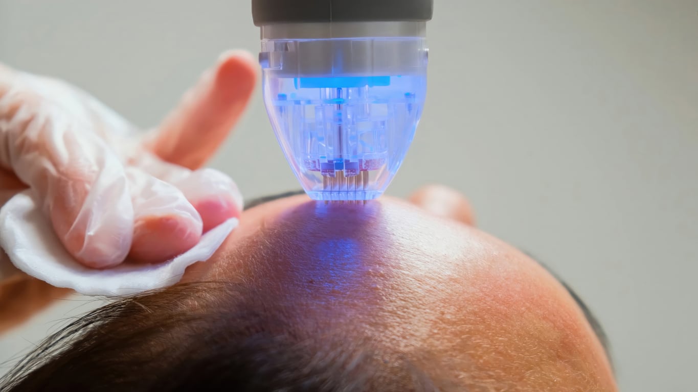 FDA Warning Links RF Microneedling to Burn Injuries and Scarring
